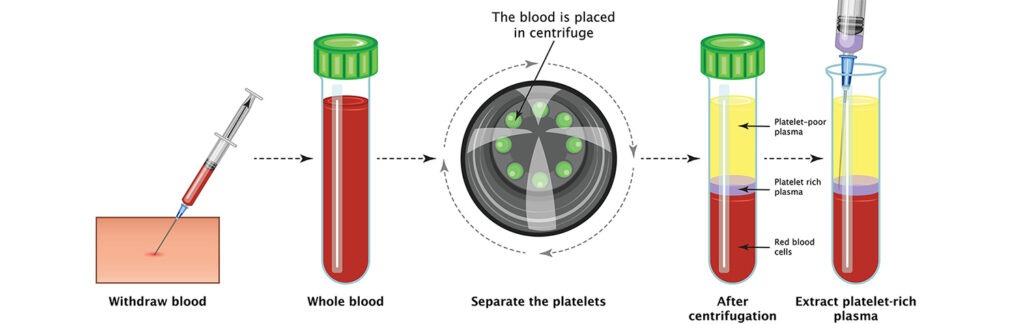 Endometrial/Ovarian PRP - Embryo Clinic