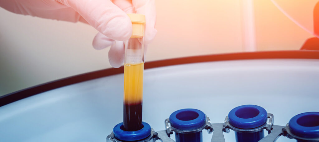 Endometrial/Ovarian PRP - Embryo Clinic